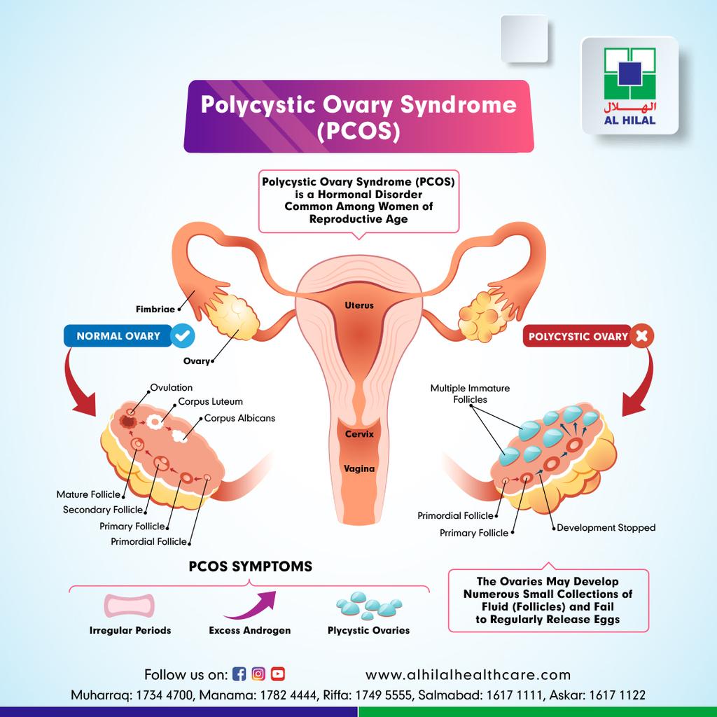 Polycystic Ovarian Syndrome