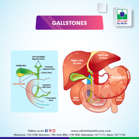 Gall Stone Cholelithiasis