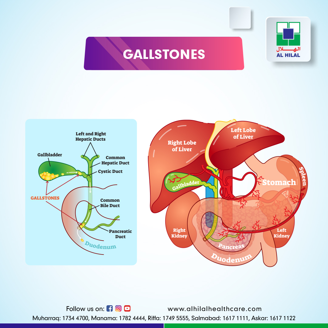 Gall Stone Cholelithiasis