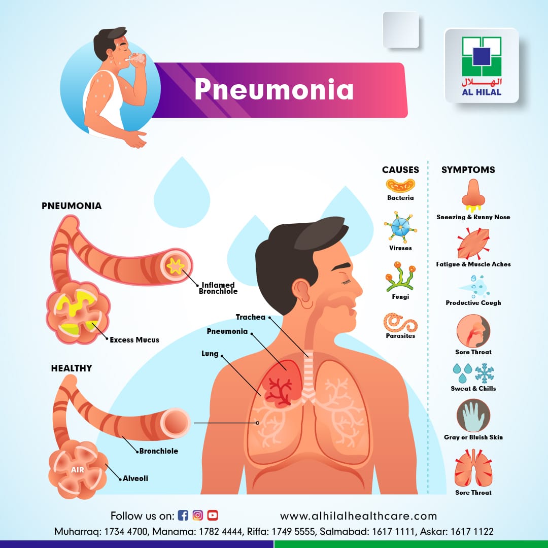 Pneumonia Alhilal Health Care Group Pneumonia Alhilal Health Care Group