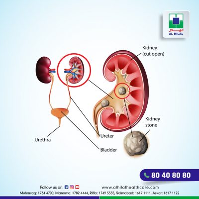 Kidney Stones