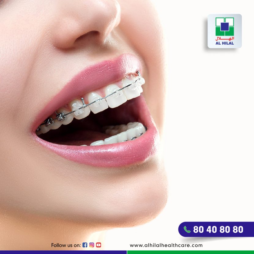 How Do Braces Work to Straighten Your Teeth?