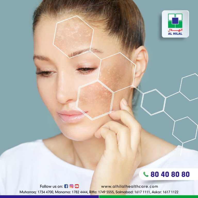 Melasma: Symptoms, Diagnosis, Treatment, and Prevention