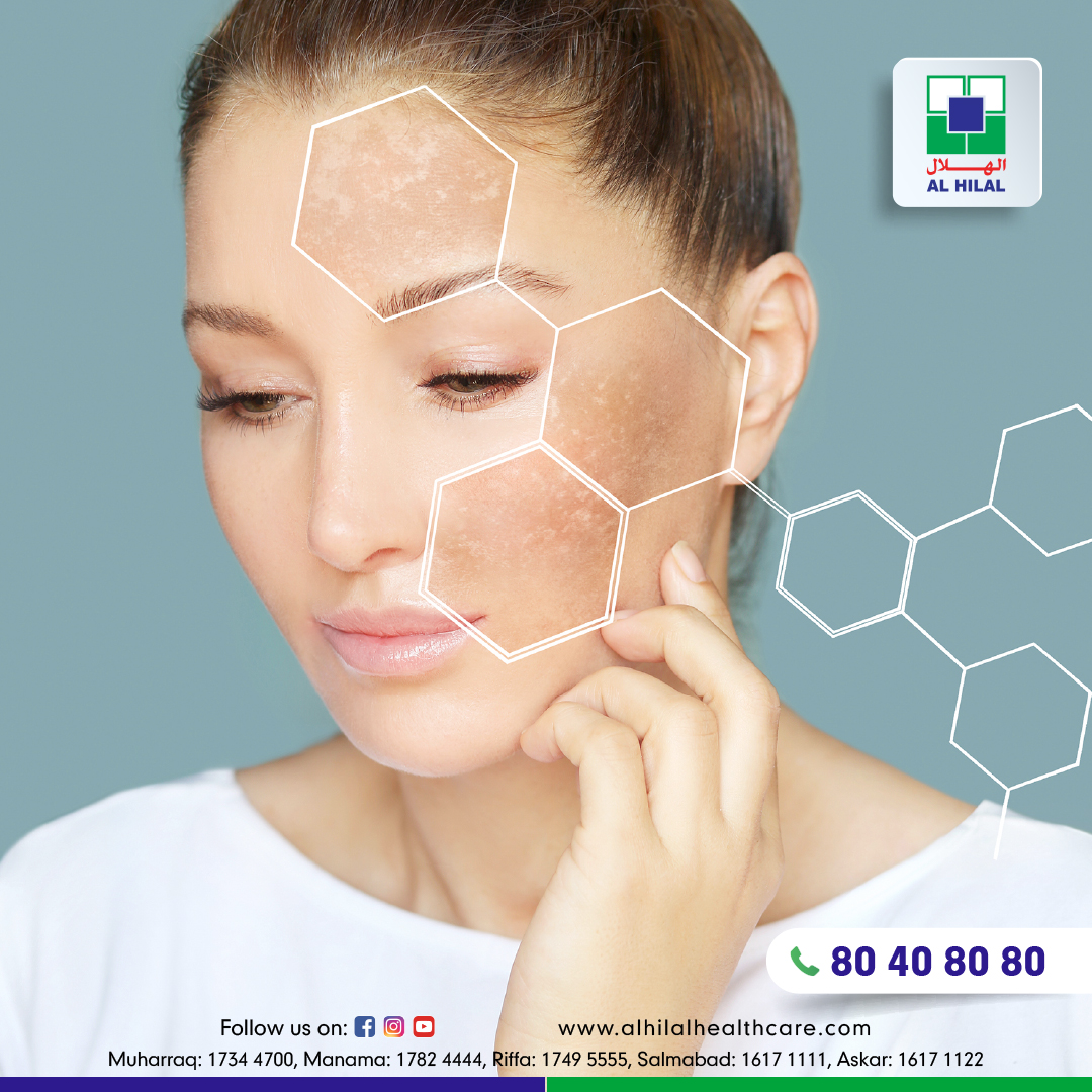 Melasma: Symptoms, Diagnosis, Treatment, and Prevention