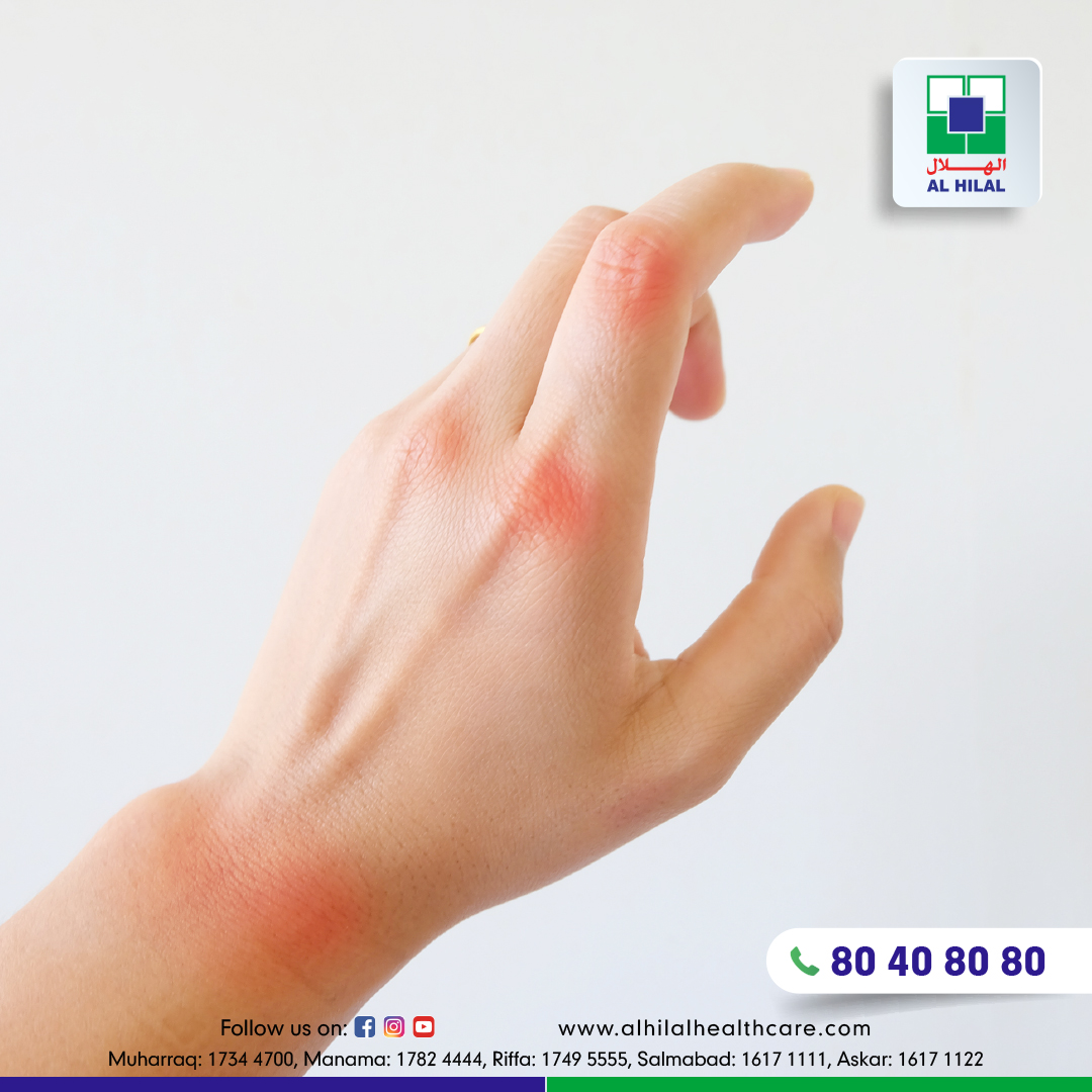 Rheumatoid Arthritis: What It Is, Types, Causes, Symptoms & Treatment ...